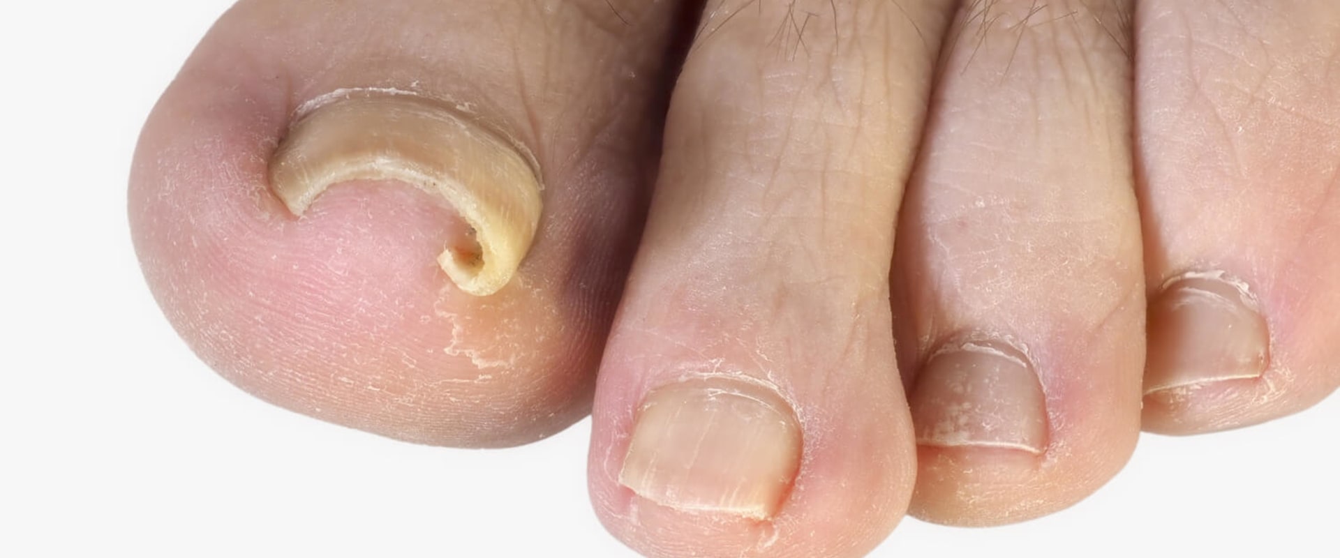 Ram's Horn Toenail Treatment That Brings Instant Relief